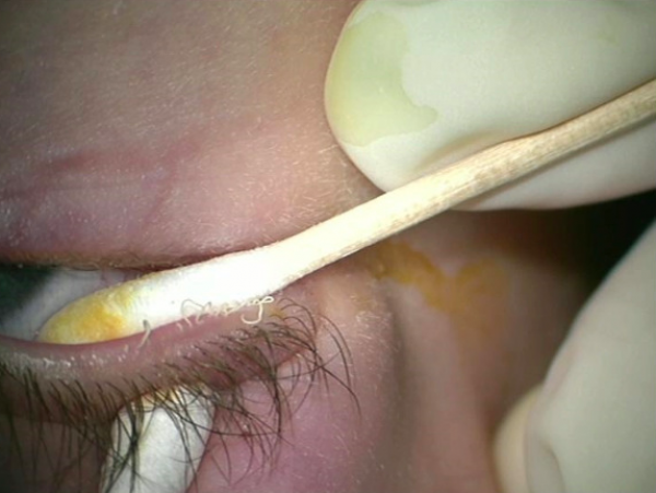 Blepharokeratoconjunctivitis (BKC) of Childhood - EyeWiki