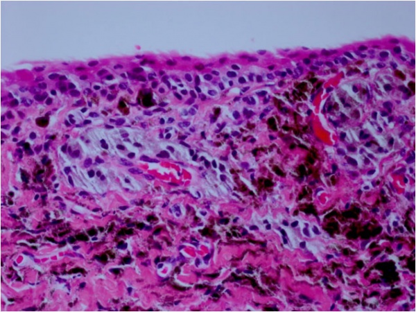 Conjunctival Melanocytic Tumors - EyeWiki