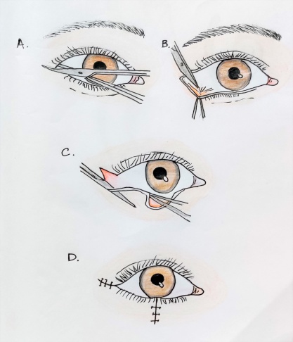 Eyelid Reconstruction - EyeWiki