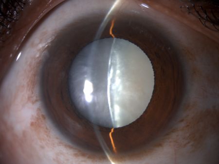 White Cataract - EyeWiki