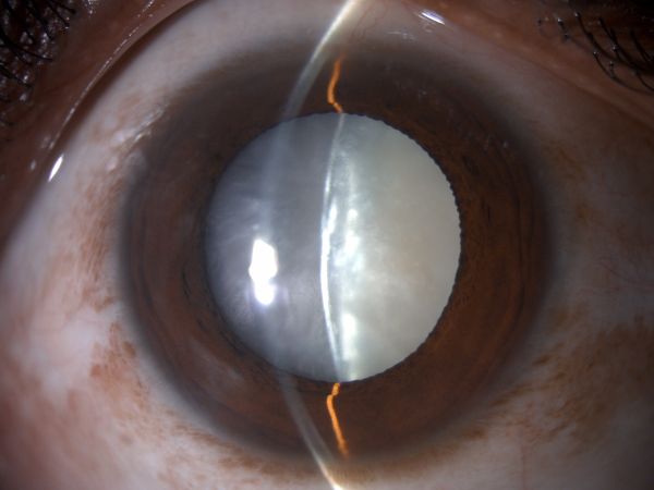 White Cataract - EyeWiki