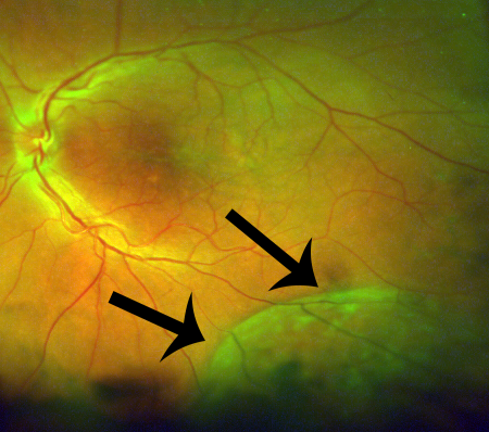Senile Retinoschisis - EyeWiki