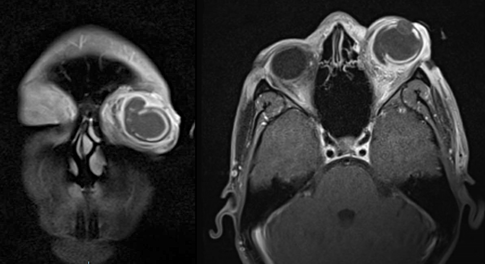 Panophthalmitis - EyeWiki