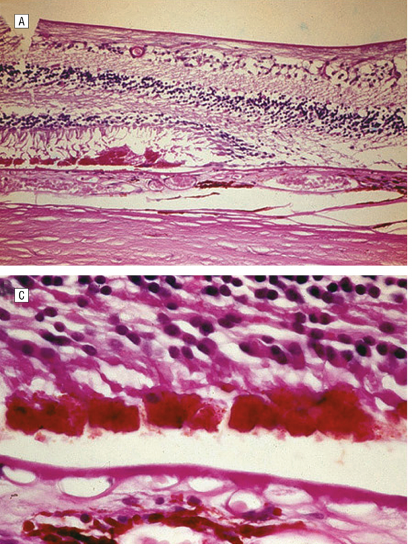 Pattern Dystrophies - EyeWiki