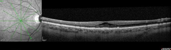 Stellate Nonhereditary Idiopathic Foveomacular Retinoschisis (SNIFR ...
