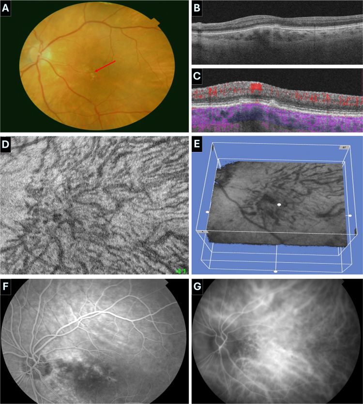 Choroidal Vascular Anomalies: Posterior Vortex Veins, Choroidal ...