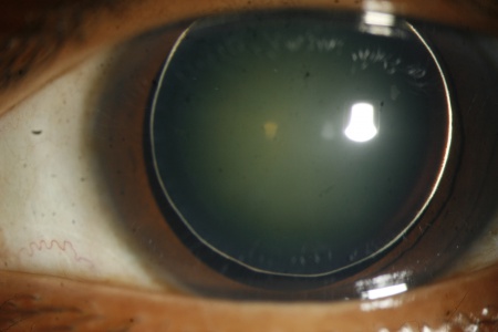 Microspherophakia - EyeWiki