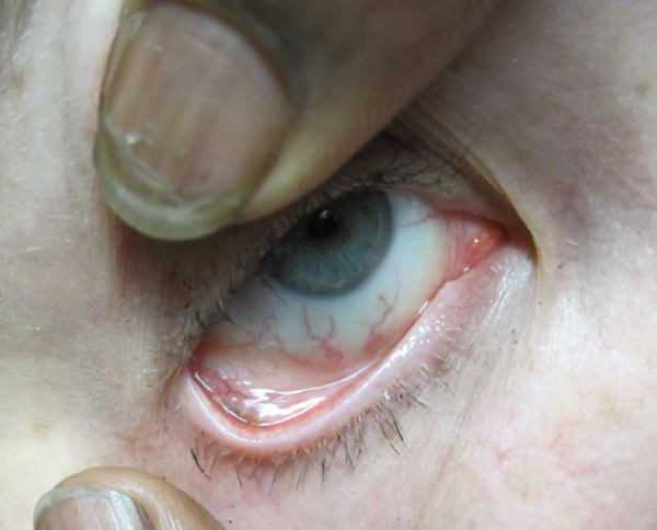 Conjunctival Concretions - EyeWiki