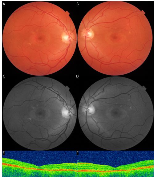 Stargardt Disease/Fundus Flavimaculatus - EyeWiki