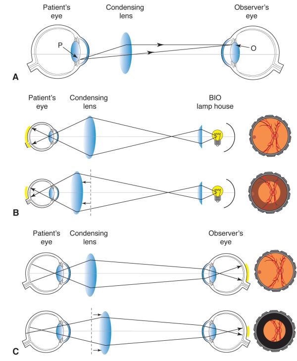 Binocular Indirect Ophthalmoscopy - EyeWiki