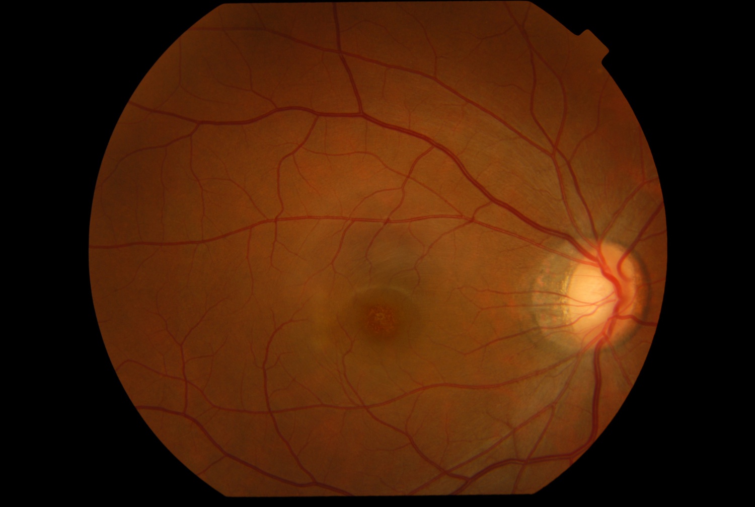 Acute Retinal Pigment Epitheliitis (Krill Disease) - EyeWiki
