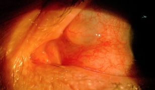 Conjunctival Inclusion Cyst - EyeWiki