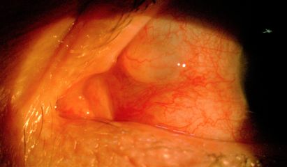 Conjunctival Inclusion Cyst - EyeWiki