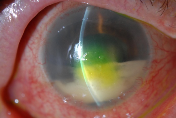 Pseudophakic Bullous Keratopathy - EyeWiki