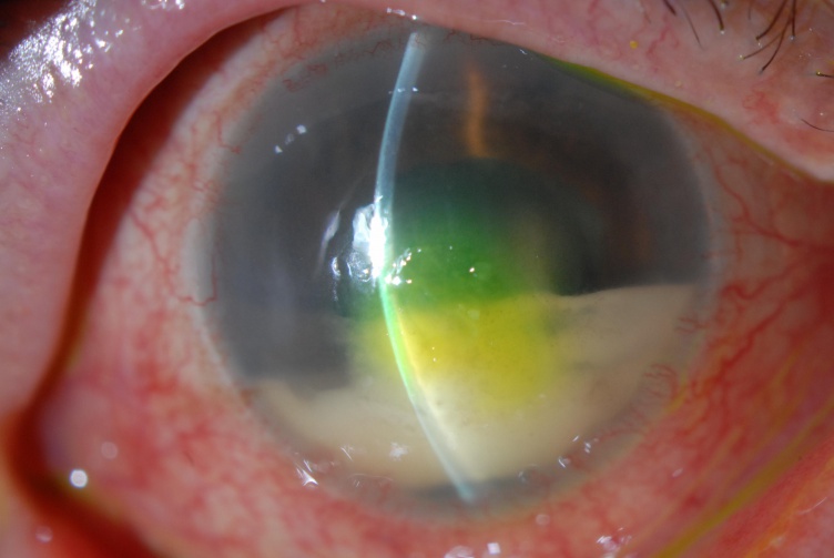 Pseudophakic Bullous Keratopathy - EyeWiki