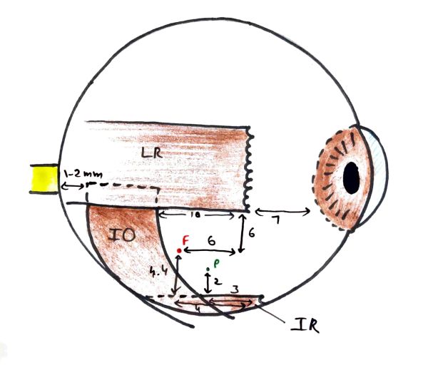Strabismus Surgery, Cyclovertical - EyeWiki