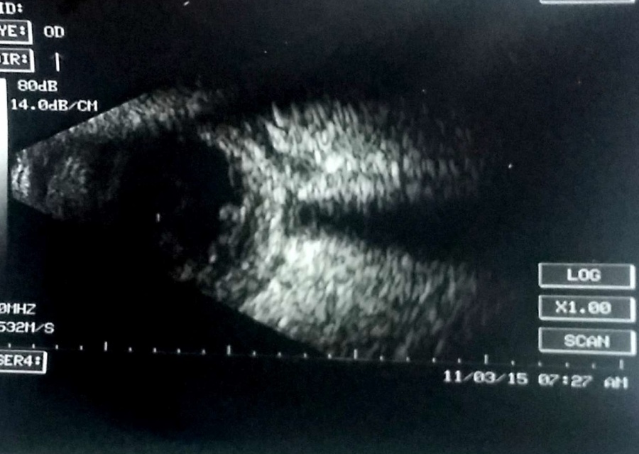 Echography (Ultrasound) - EyeWiki