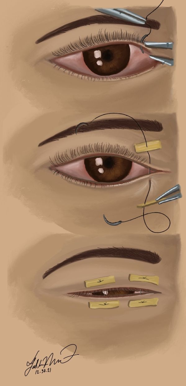 Tarsorrhaphy - EyeWiki