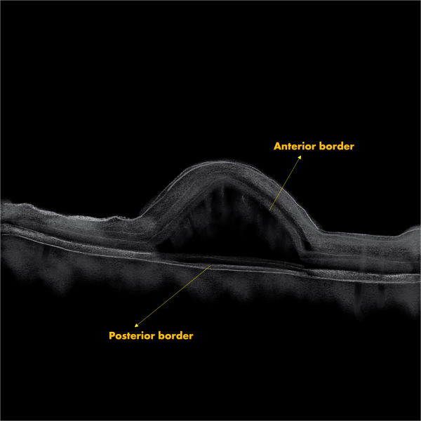 Bacillary Layer Detachment in Retina - EyeWiki