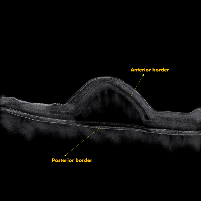 Bacillary Layer Detachment in Retina - EyeWiki