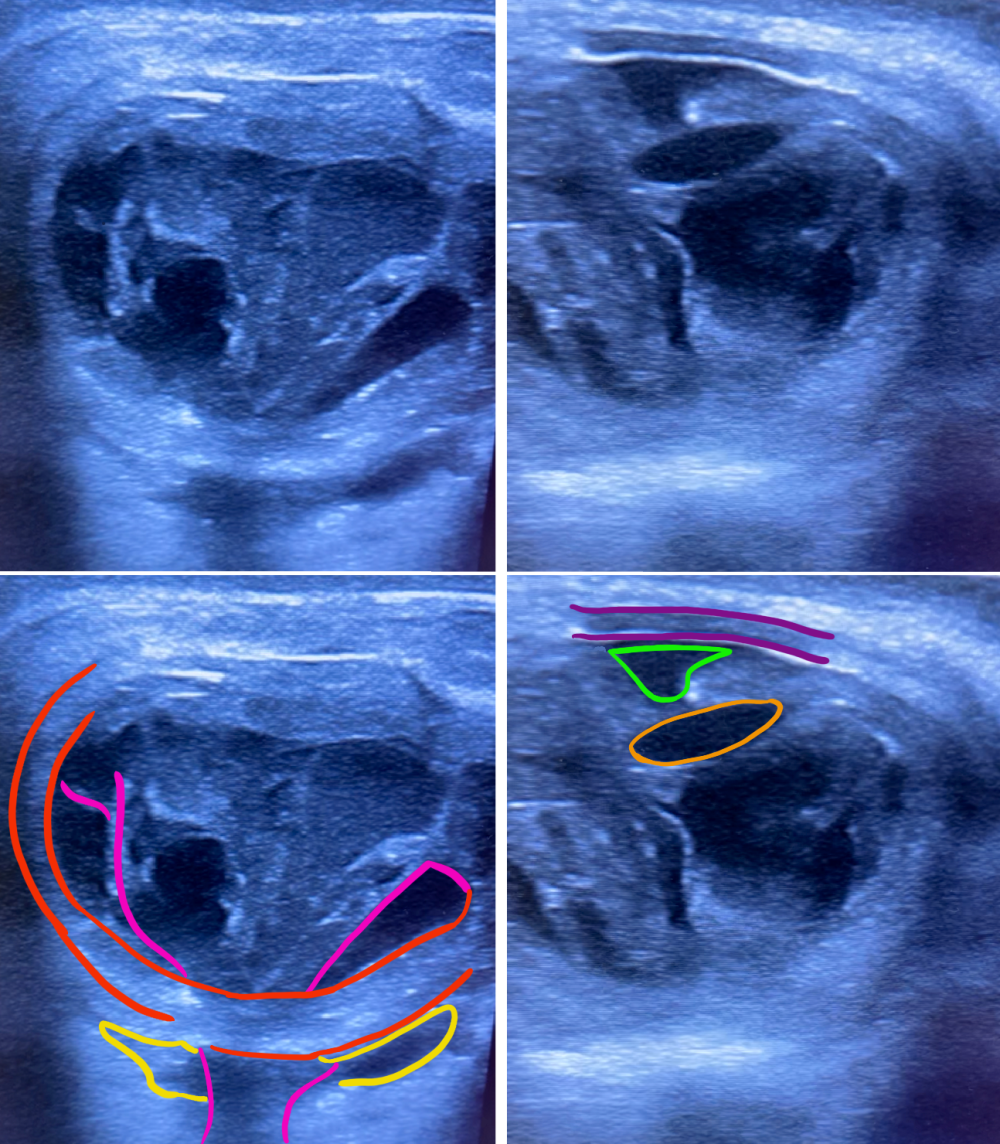 Panophthalmitis - EyeWiki