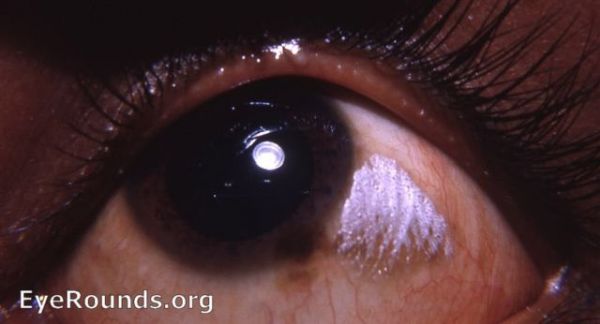 Xerophthalmia - EyeWiki