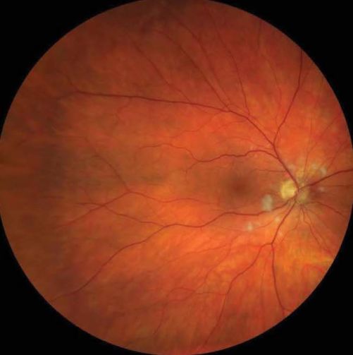 Cotton Wool Spots - EyeWiki