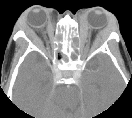Nonspecific Orbital Inflammation (Idiopathic Orbital Inflammation ...