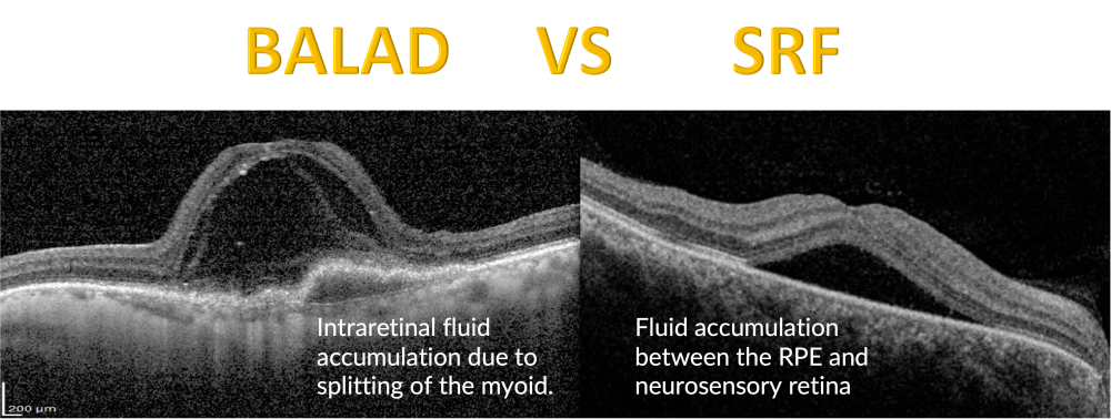 Bacillary Layer Detachment in Retina - EyeWiki