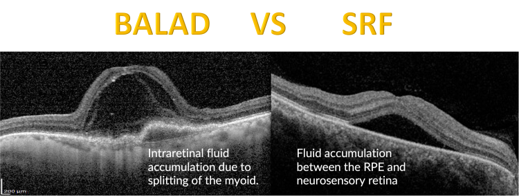 Bacillary Layer Detachment in Retina - EyeWiki