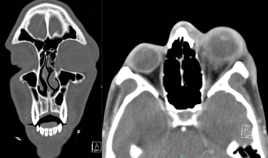 Panophthalmitis - EyeWiki