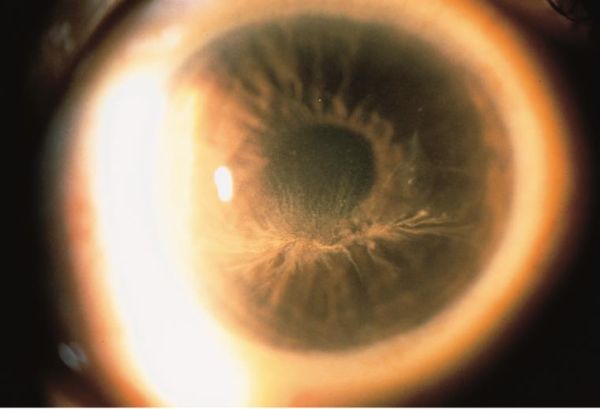 Cornea Verticillata - EyeWiki