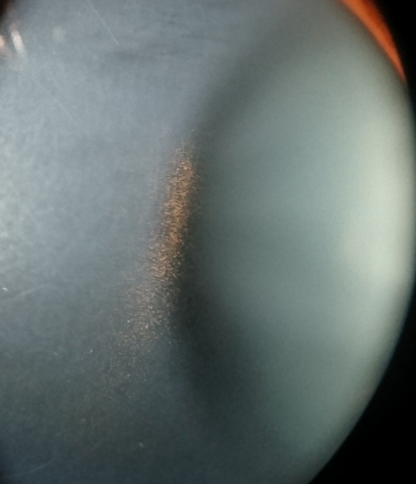 Pigmentary Glaucoma and Pigment Dispersion Syndrome - EyeWiki