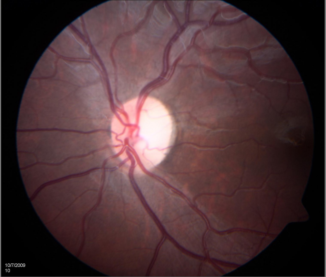 Optic Atrophy - EyeWiki