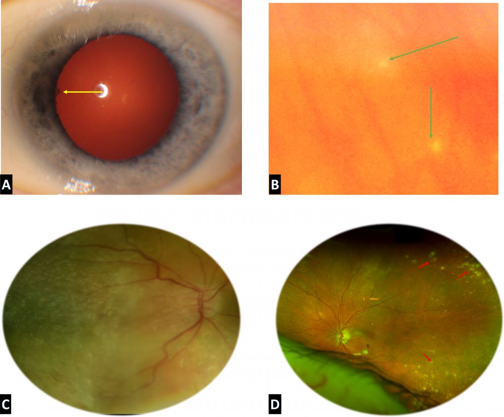 Sarcoid Uveitis - EyeWiki