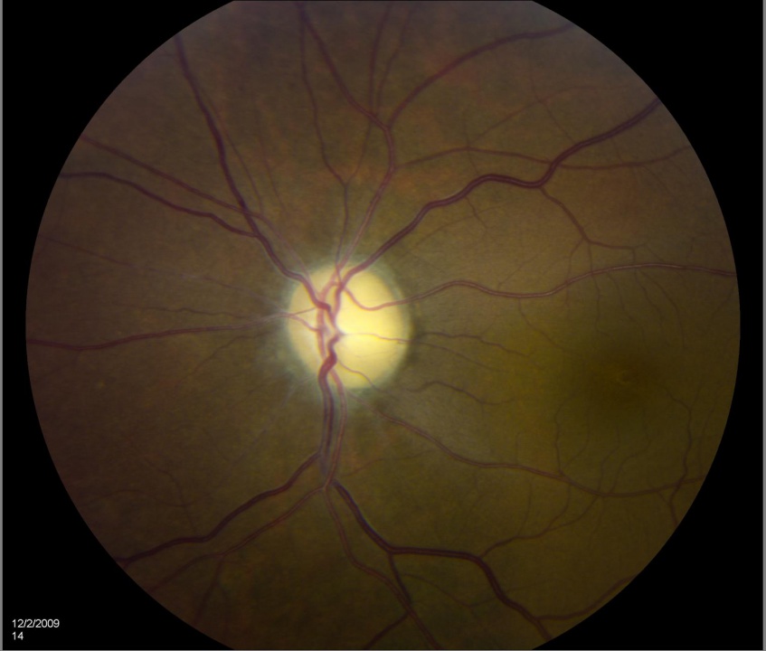 Optic Atrophy - EyeWiki