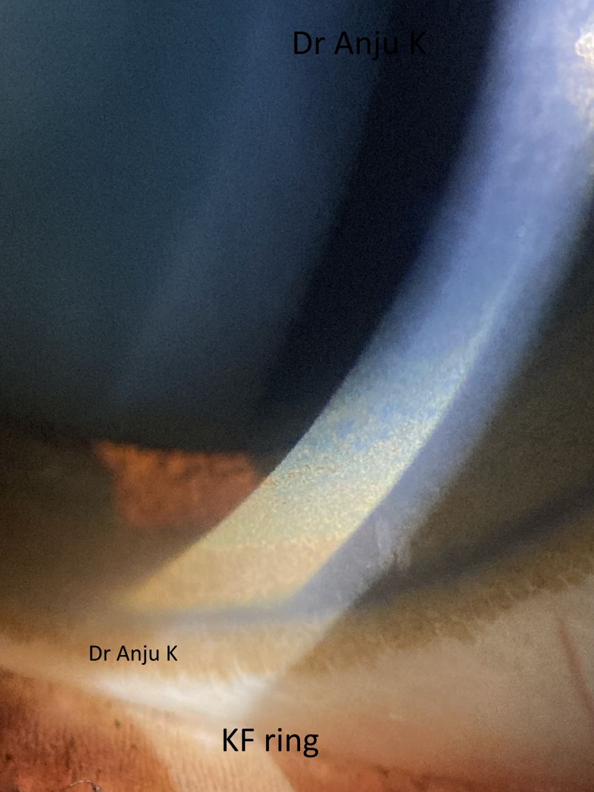 Wilson's Disease/Kayser Fleischer Ring - EyeWiki