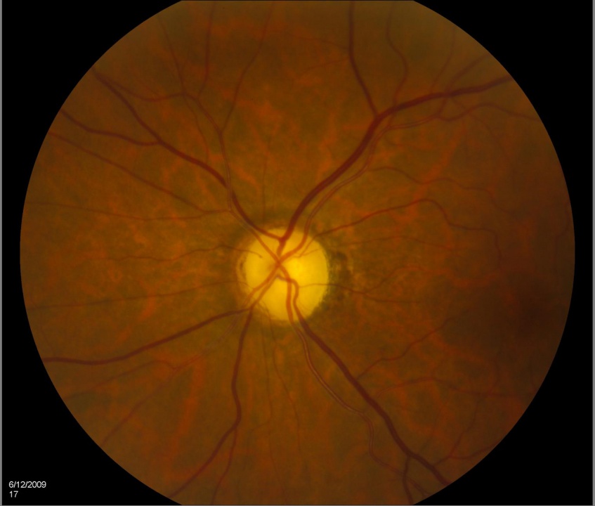 Optic Atrophy - EyeWiki
