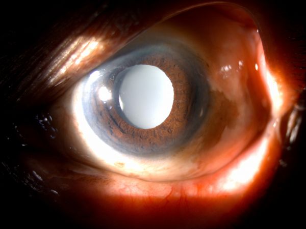Intraocular Lens Opacification - EyeWiki