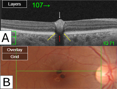 Congenital Simple Hamartoma of the Retinal Pigment Epithelium (CSHRPE ...