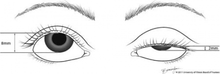 Margin to Reflex Distance 1,2,3 - EyeWiki