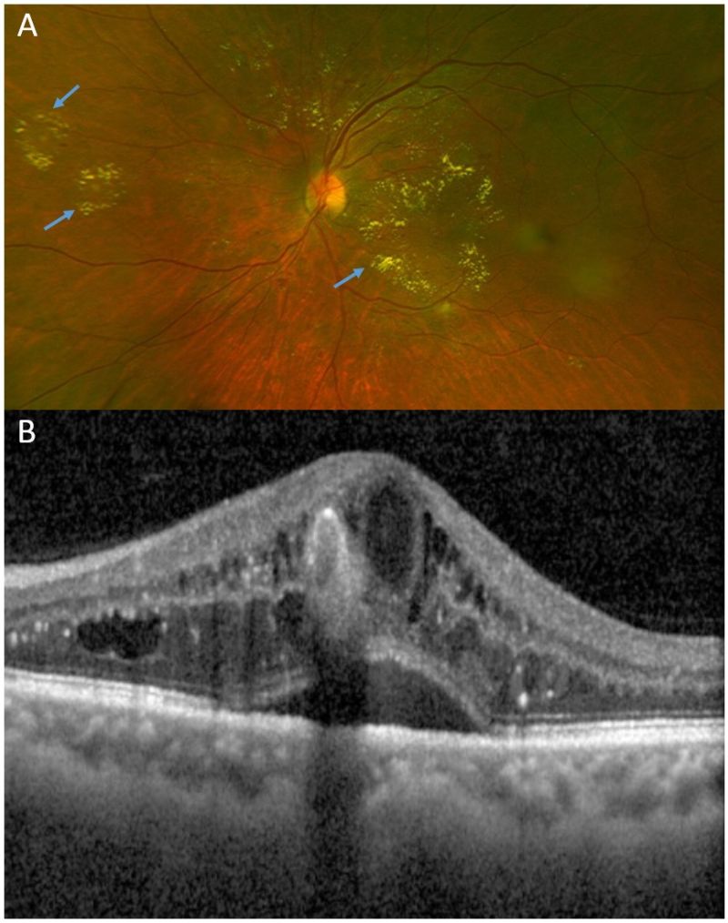 Diabetic Macular Edema - EyeWiki