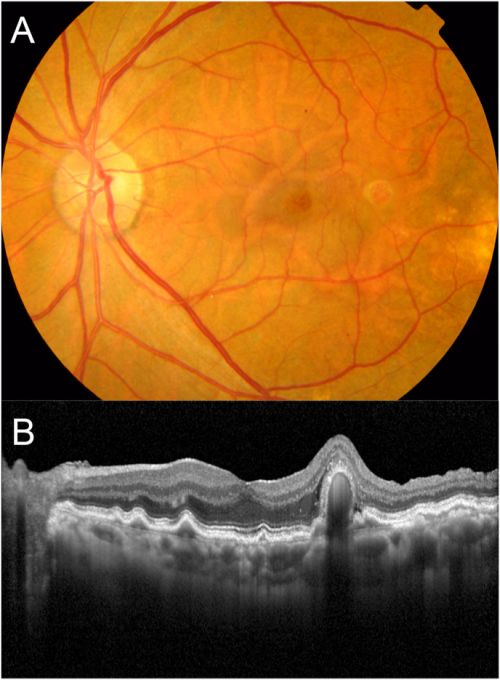 Choroidal Vascular Anomalies: Posterior Vortex Veins, Choroidal ...
