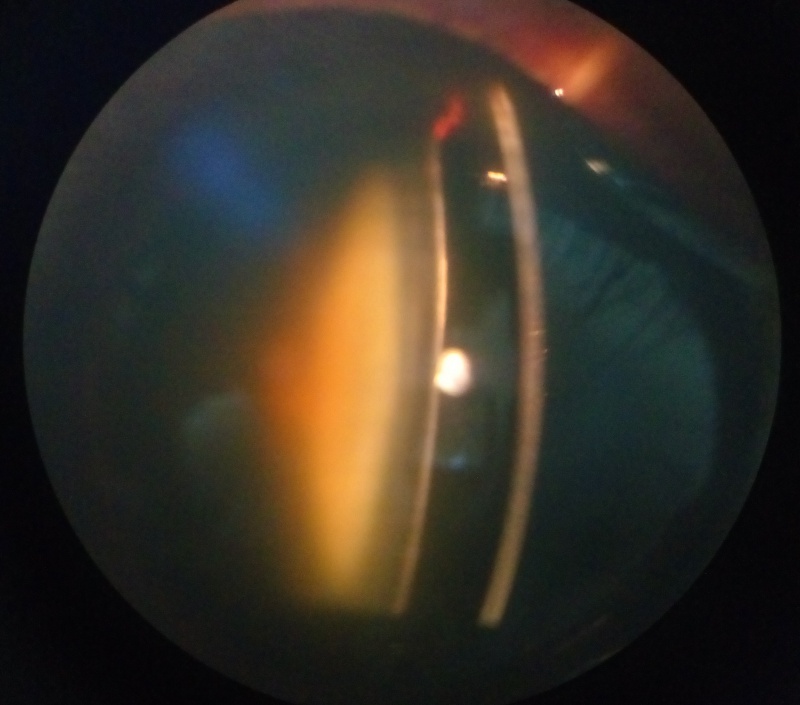 Cataract - EyeWiki