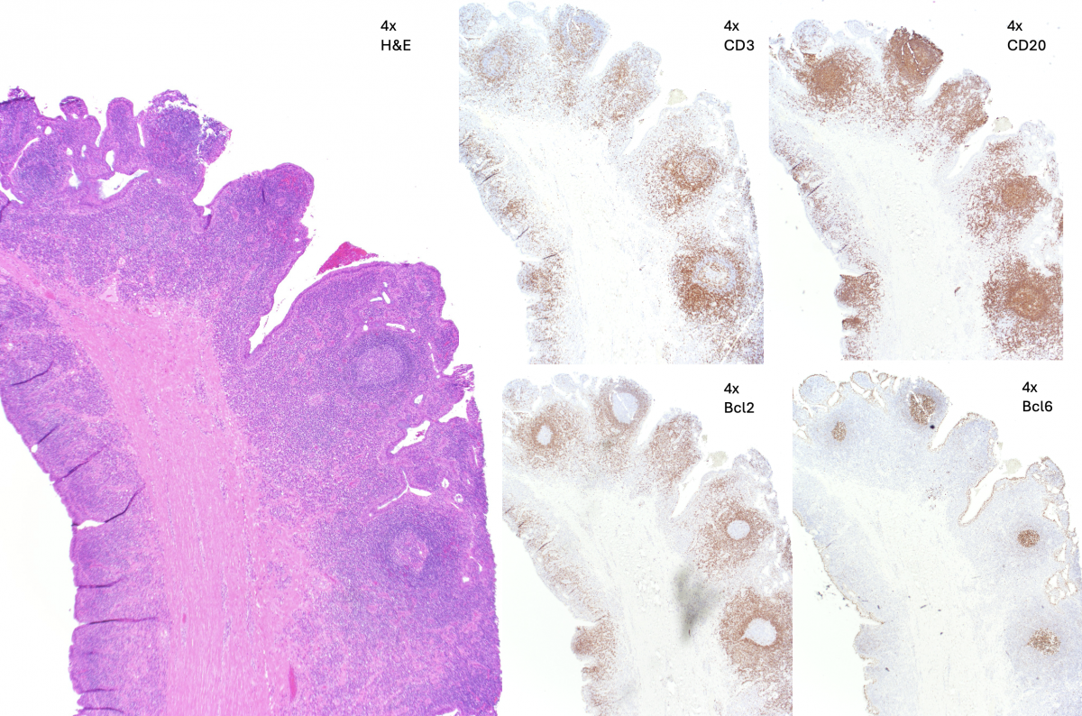 Ocular Manifestations of Bosma Arrhinia Microphthalmia Syndrome (BAMS ...