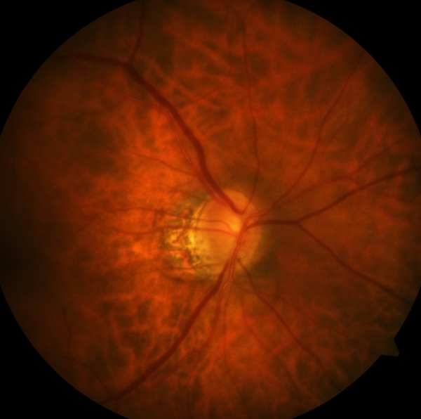 Tilted Disc Syndrome - EyeWiki