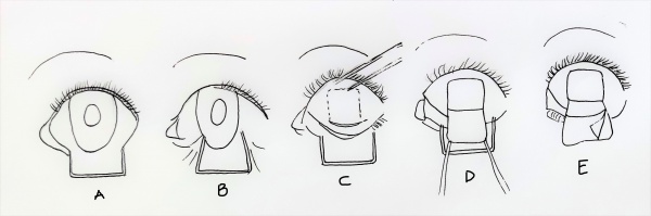 Eyelid Reconstruction - EyeWiki
