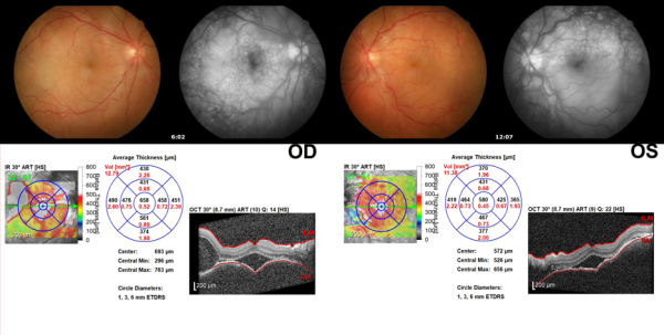 Systemic Chemotherapy and Ocular Toxicities - EyeWiki
