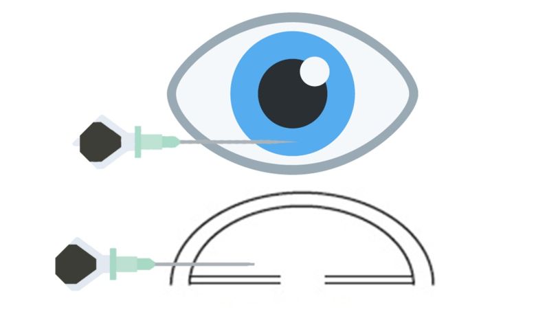 Anterior Chamber Paracentesis in Uveitis - EyeWiki