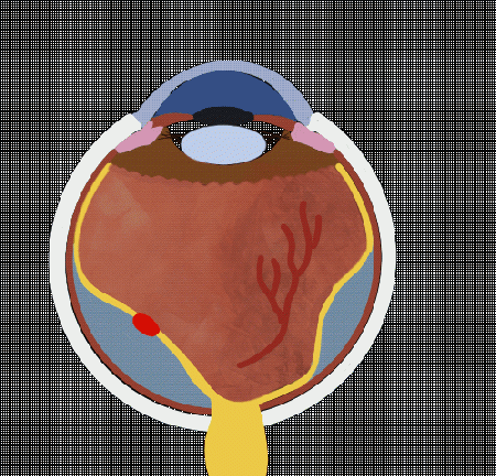 Macula-on Rhegmatogenous Retinal Detachment - EyeWiki